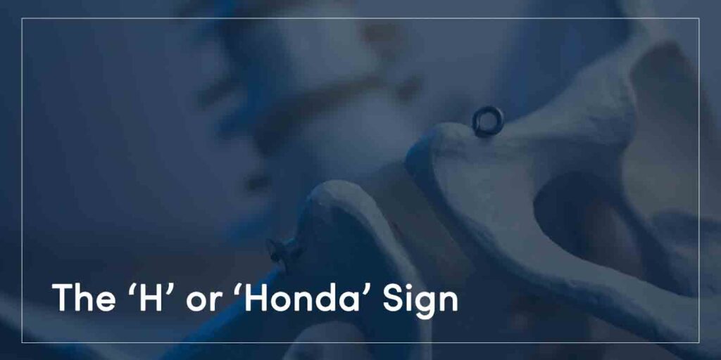 The ‘H’ or ‘Honda’ Sign | HSU Clinical & Rehabilitation Services
